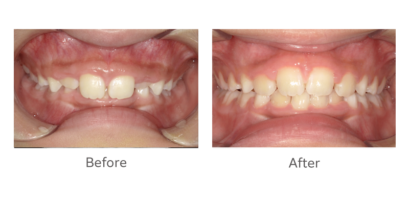 [Case Study] A 7-year-old boy who achieved correct tooth alignment and ...